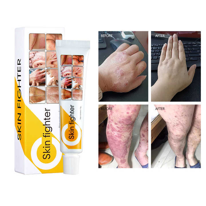 Professional Skin Care Cream Expert Skin Fighter for Psoriasis and ...