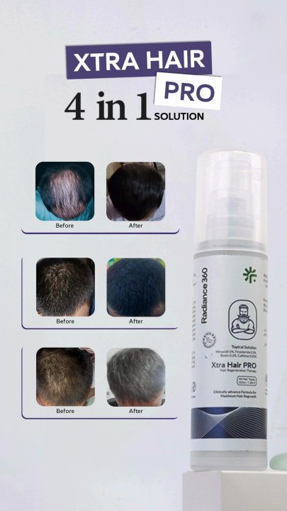 Xtra Hair Pro - Hair Serum - Tropical Solution (Minoxidil 6% ...