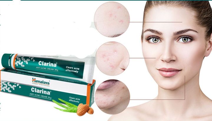 Clarina Anti-Acne Cream - Clears acne effectively and safely - 30gm ...