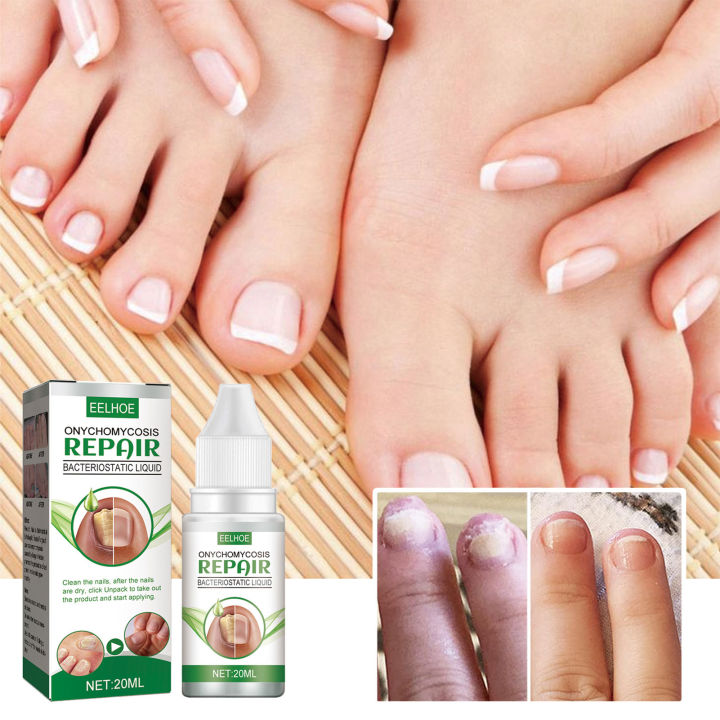 20ml Nail Fungus Repair Solution Nail Bacteria Prevent Gel Damage Fix ...