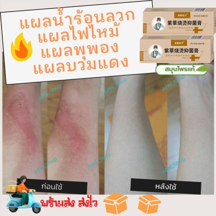 Kangmintang hot scald wound dressing cream fire scar burn hot scald ...