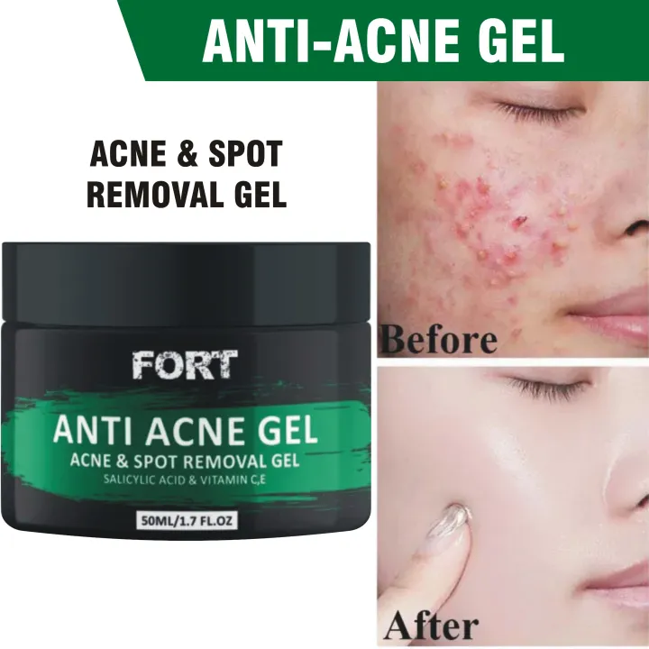 Fort Anti Acne Gel For Acne & Spot Removal With Salicylic Acid ...