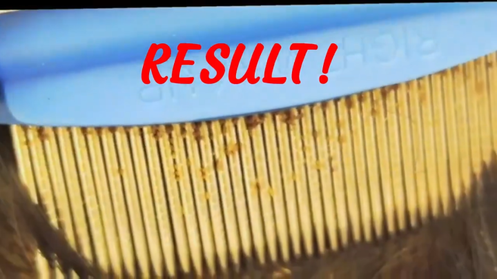 V Comb Electronic Head Lice Removal Machine Anti Lice Machine ...