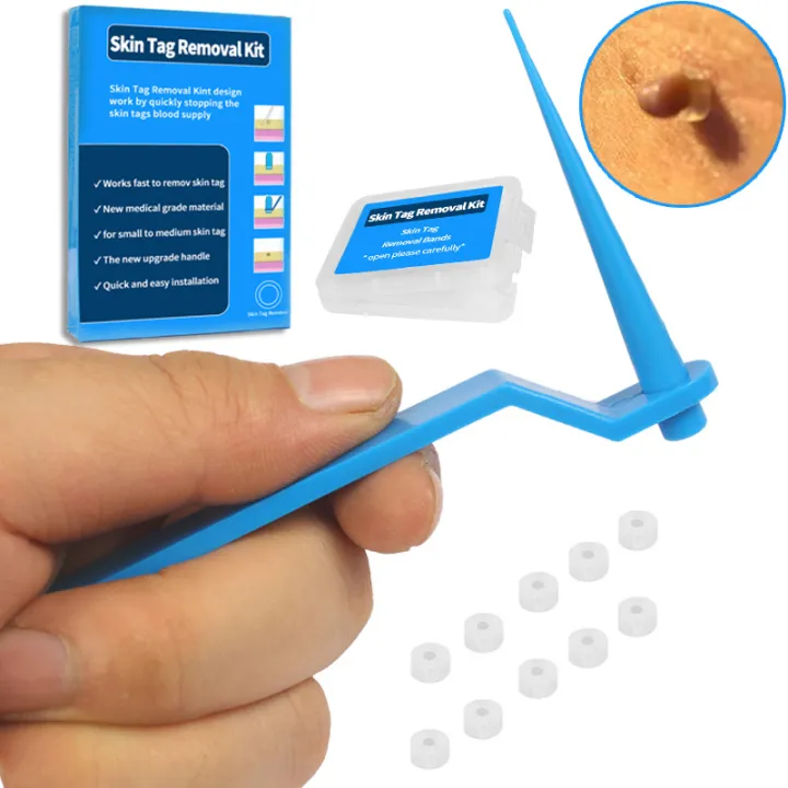 1 Set Skin Tag Removal Kit Skin Mole Wart Remover Micro Band Skin Tag ...