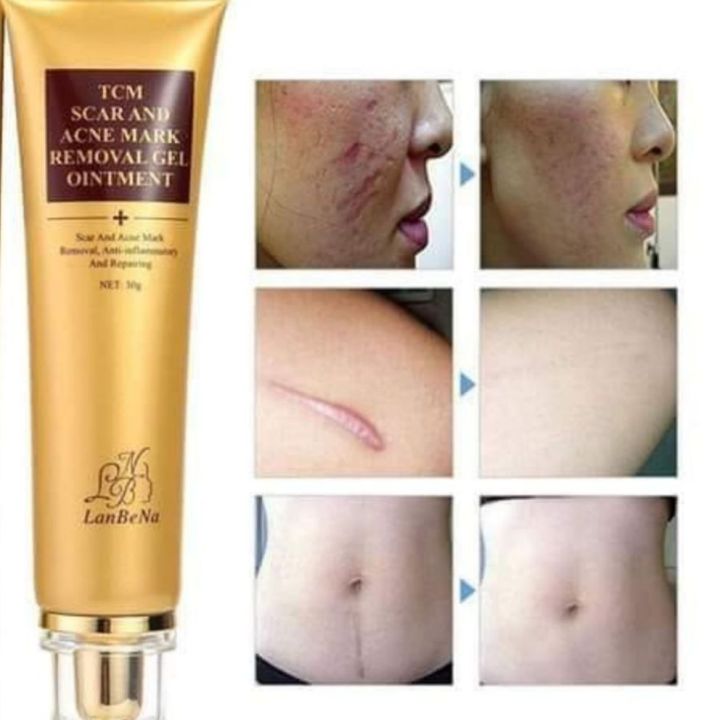 acne spots stretch mark 30 ml | Daraz.com.bd