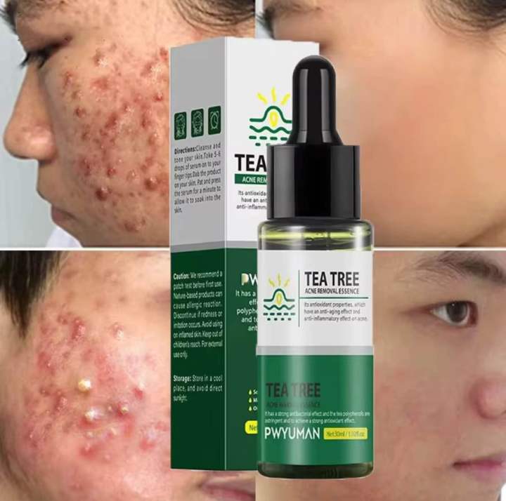 Tea Tree Acne Removal Serum Repair Pimple Spots Shrink Pore Remove ...
