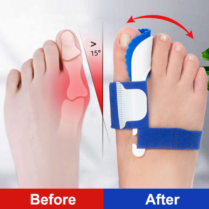 1 Pair Bunion Device Hallux Valgus Orthopedic Braces Toe Correction ...