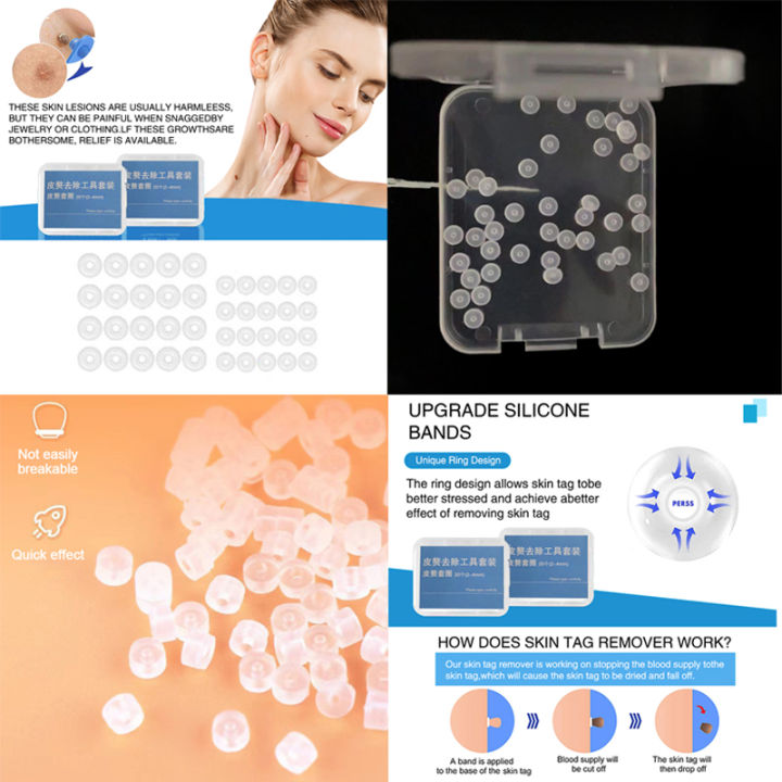 20 Pcs/Box Flesh Nevus Removal Bands Non-Toxic Mole Removal Rubber ...