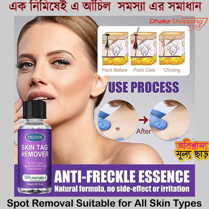 Skin Tag Remover Wart Remover Skin Tag Removal Quickly and Easily ...