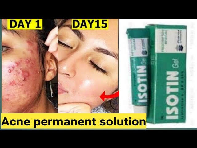 Isotin gel 10gm | Daraz.pk: Buy Online at Best Prices in Pakistan ...