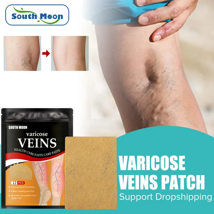 South Moon Varicose Veins Patch Treatment Vasculitis Phlebitis Spider ...