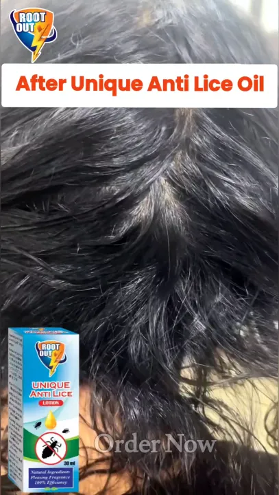 Anti-Lice Lotion – Buy 2 Get 1 Free | 30ml | Unique Formula | Kills ...