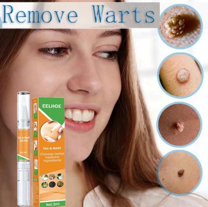 Genuine corn warts removal and wart removal. corn warts removal is safe ...