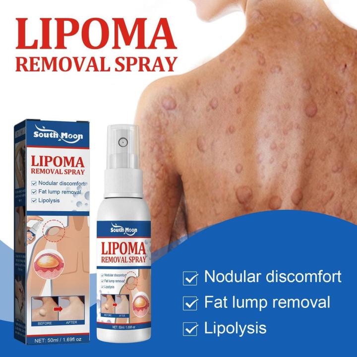 Lipomas Removal Spray Relief Pain Treat Skin Swelling Ointment ...