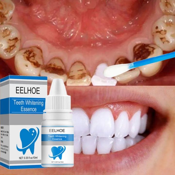 Advanced Teeth Whitening Serum: Removes Plaque & Stains, Freshens ...