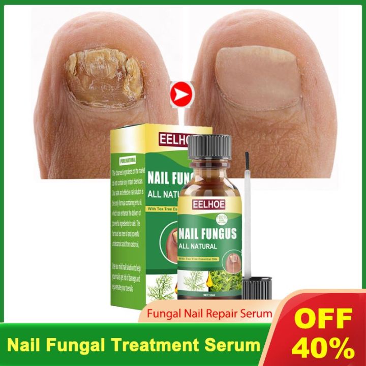 30ml Nail Fungal Treatment Feet Serum Anti Infection Foot Toe Fungus Removal Essence Gel ...