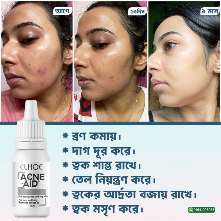 ELHOE Acne Aid Serum Drops - Your Ultimate Solution for Acne, Pimple ...