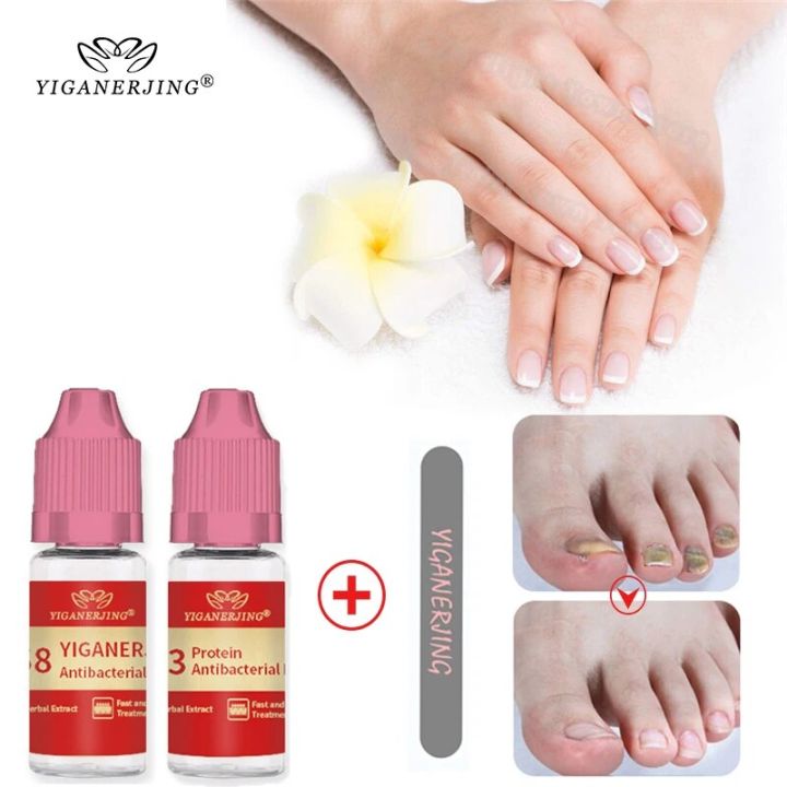 YIGANERJING 10ml Fungal Nail Solution Treatment Onychomycosi Paronychia ...