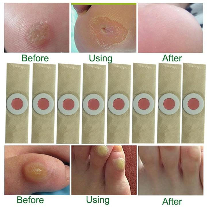 06 pcs Medical Plasters Foot Corn Removal Warts Thorn Patch Curative ...