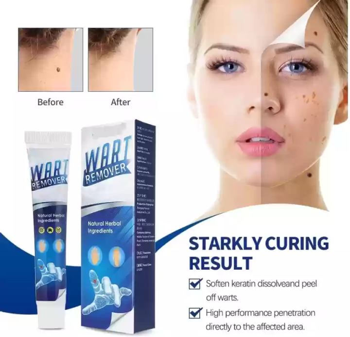 Warts Remover Ointment Wart Treatment Cream Skin Tag Remover Ointment ...