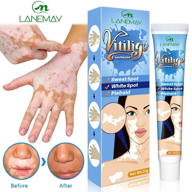 20g Herbal Extract Vitiligo Ointment Remove Ringworm White Spot Removal ...