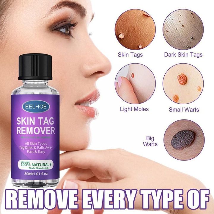 10 ML Tags Moles Removal Serum Mole Skin Painless Stain Health Skin ...