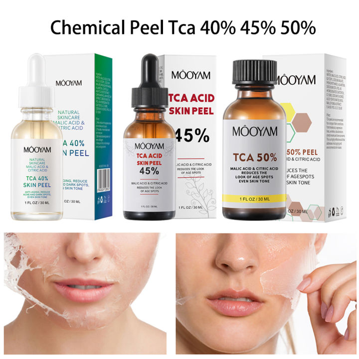 30ml Chemical Peel 40% 45% 50% Facial Peeling Serum Citric Acid Peeling ...