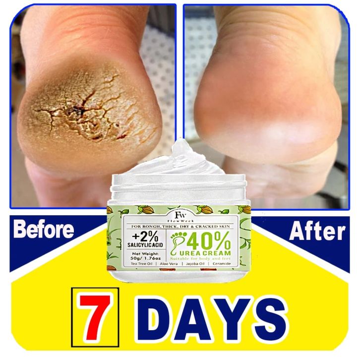 Urea Anti Drying Foot Cream Crack Heel Cream Removal Feet Calluses Dead ...