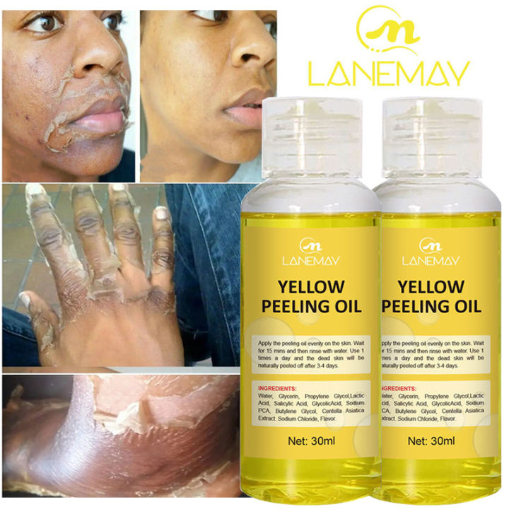 【New and Improved】 Strong Yellow Peeling Oil Bleach Dark Skin Whiten ...