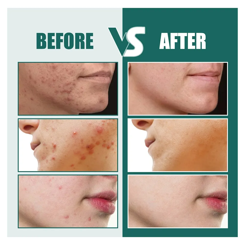 112pcs Pimple Patches Fade Face Spot Repair Star Shaped Pimple Acne ...