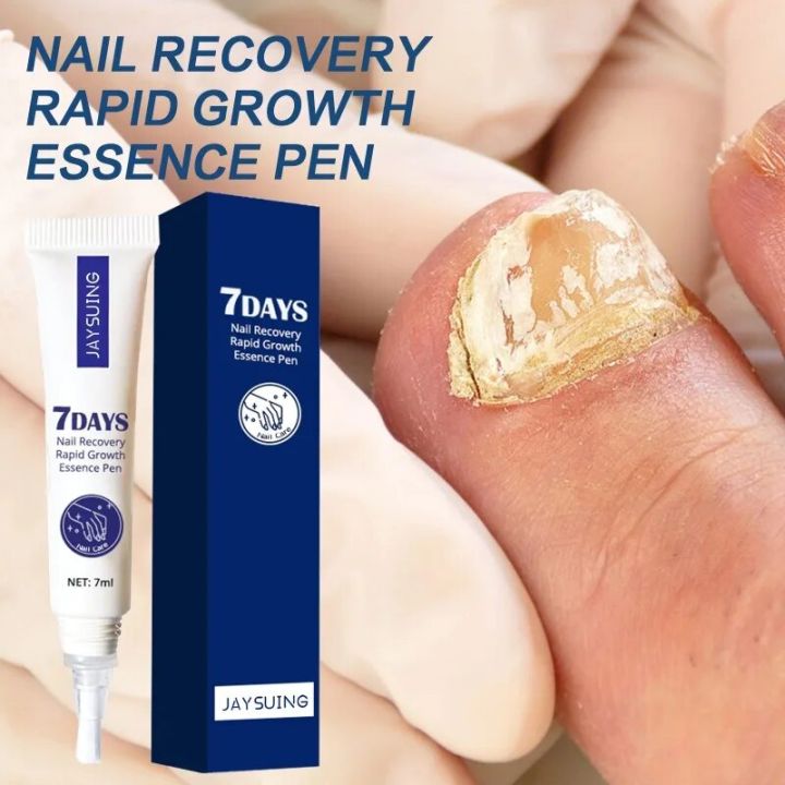 Nail Fungal Treatment Serum Onychomycosis Paronychia Anti Infection Repair Toenail Fungus Hand ...