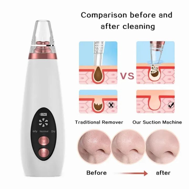Nose Black head Remover Vacuum Acne Pimple,Black Spot Suction Electric ...