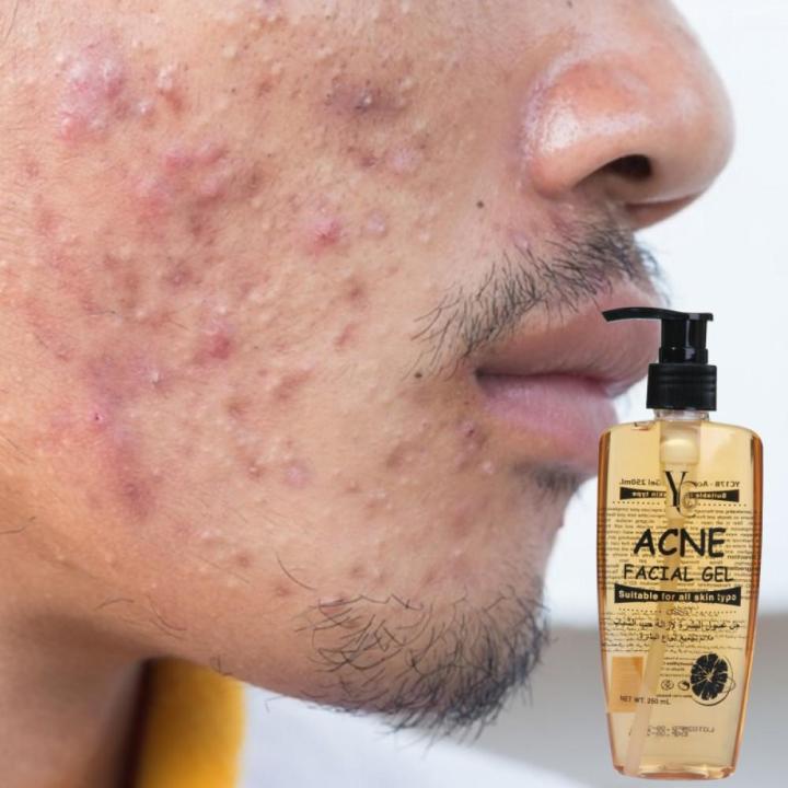 YC Acne Facial Gel: 250 Ml | Daraz.com.bd