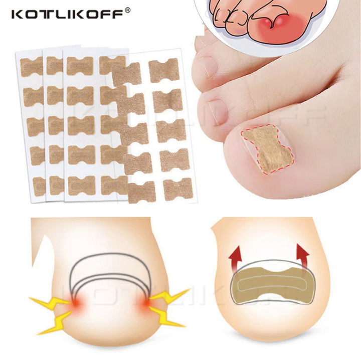 KOTLIKOFF Toenail Correction Stickers Ingrown Toenail Stickers ...