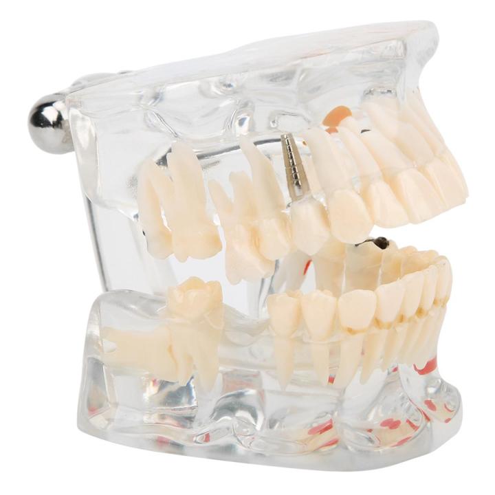 Pathology Model With Missing Tooth Tooth-tooth For Dental Experimental ...