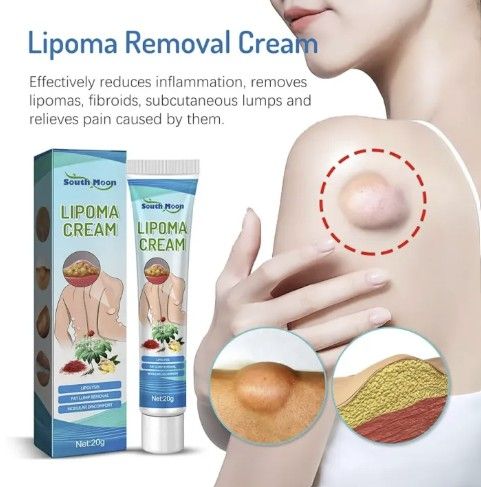 Lipoma Removal Cream Lipolysis Fat Lump Relieve Plaster Skin Swelling ...