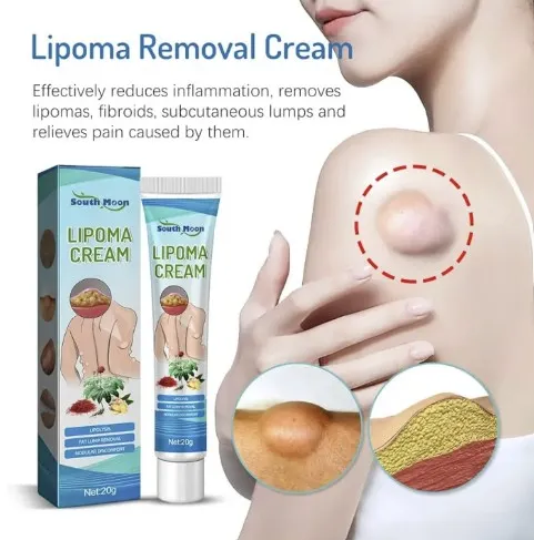 Lipoma Removal Cream Lipolysis Fat Lump Relieve Plaster Skin Swelling ...