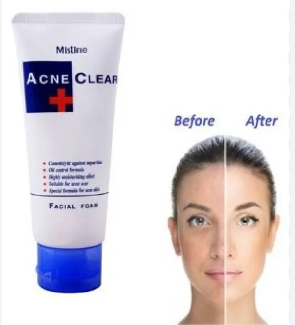 MISTINE ACNE SCAR CLEAR OIL BLEMISH CONTROL FACIAL FOAM FACE WASH-85G (MADE IN THAILAND) | Daraz ...