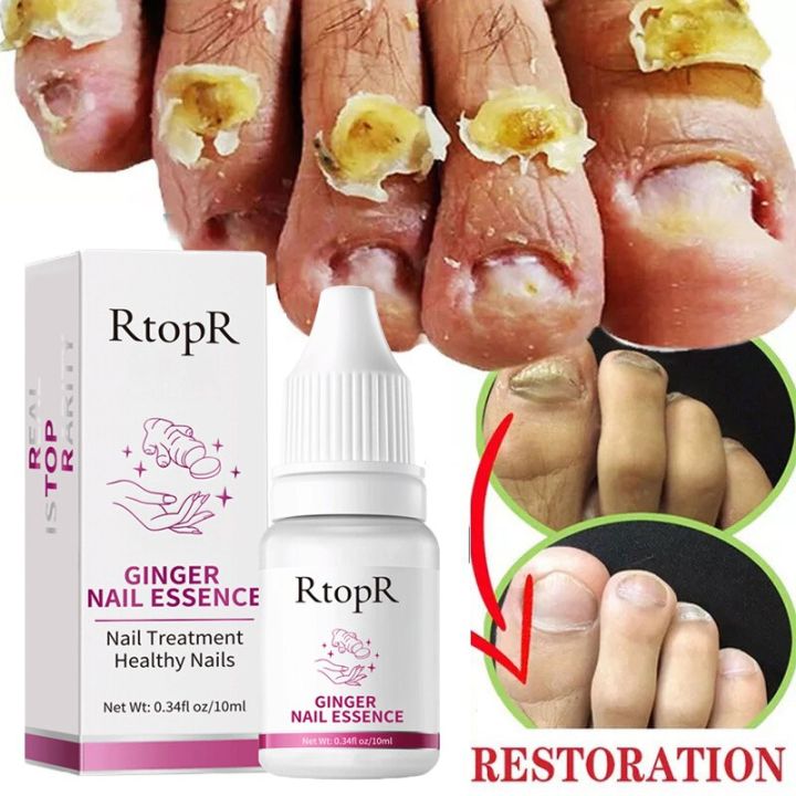 7 Days Ginger Nail Fungal Treatment Serum Onychomycosis Paronychia Anti ...