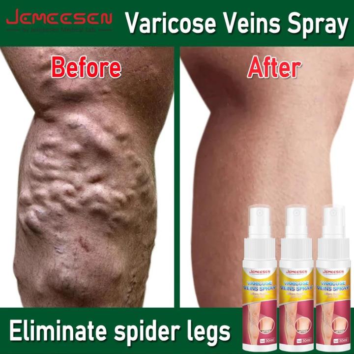 Jemeesen Varicose Vein Spray Relieve Legs Dilated Vasculitis Phlebitis ...