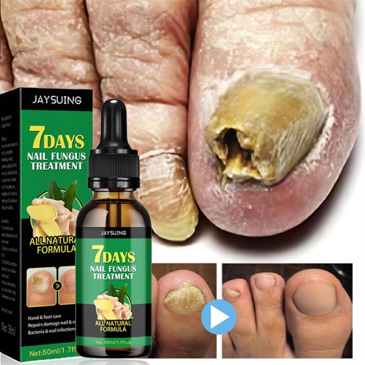 7 Days Nail Fungal Treatment Essence Oil Foot Toe Nail Fungus Removal Serum Repair Onychomycosi ...