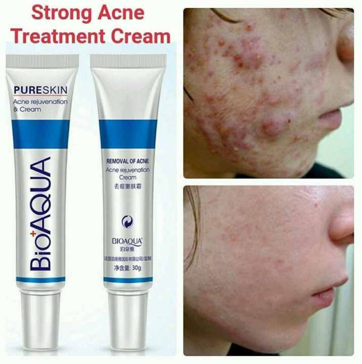 Bioaqua Pure Skin Acne Removal and Rejuvenation Cream 30 gm | Daraz.com.bd