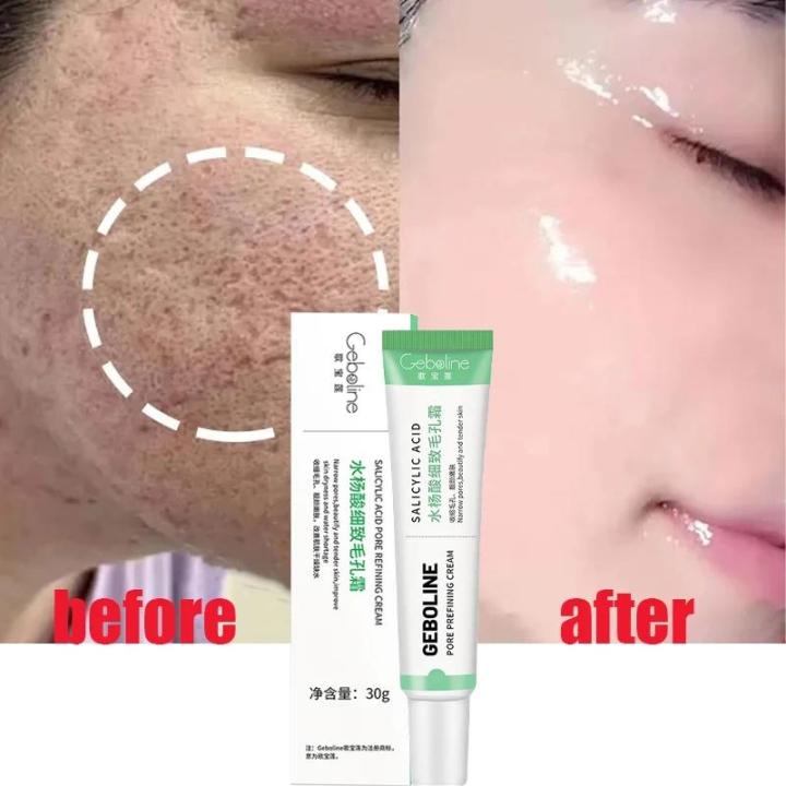 Salicylic Acid Pore Shrinking Cream Tighten Face Smooth Skin ...