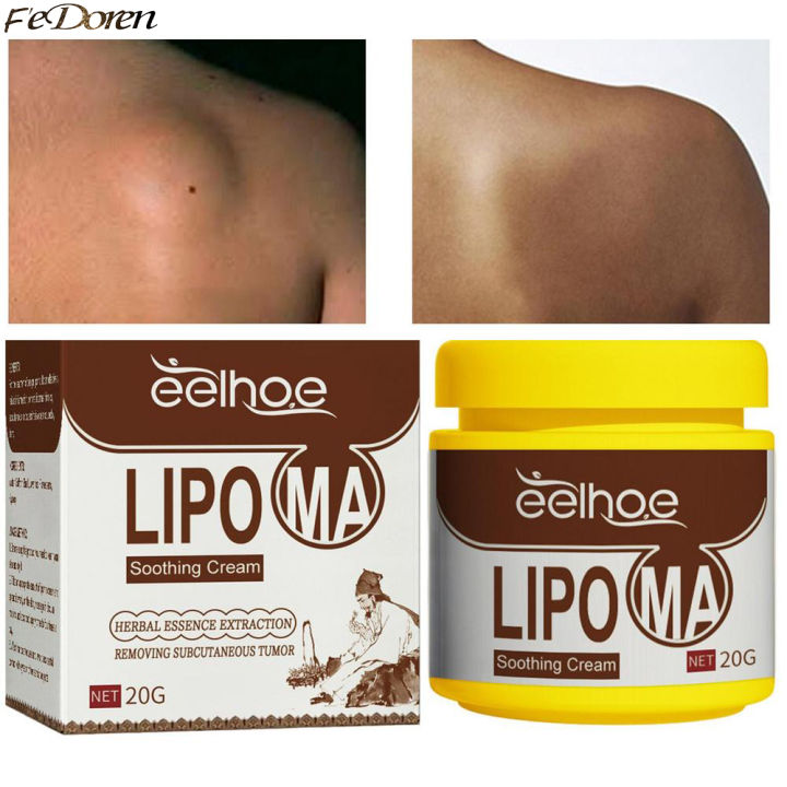 Lipoma Removal Cream Lipolysis Fat Lump Relief Cream Skin Swelling Fat ...