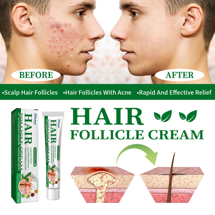Hair Follicle Cream Treat Scalp Hair Folliculitis Skin Inflammation ...