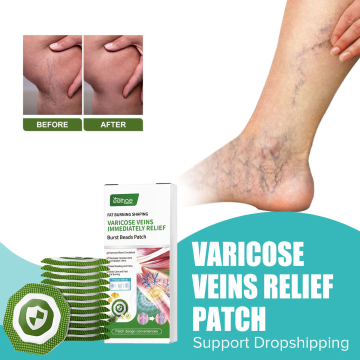 Varicose Vein Patches Swelling Treatment Vasculitis Phlebitis Spider ...
