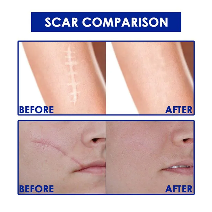Effective Scar Removal Cream New Old Scars Cream Surgical Scars Stretch ...