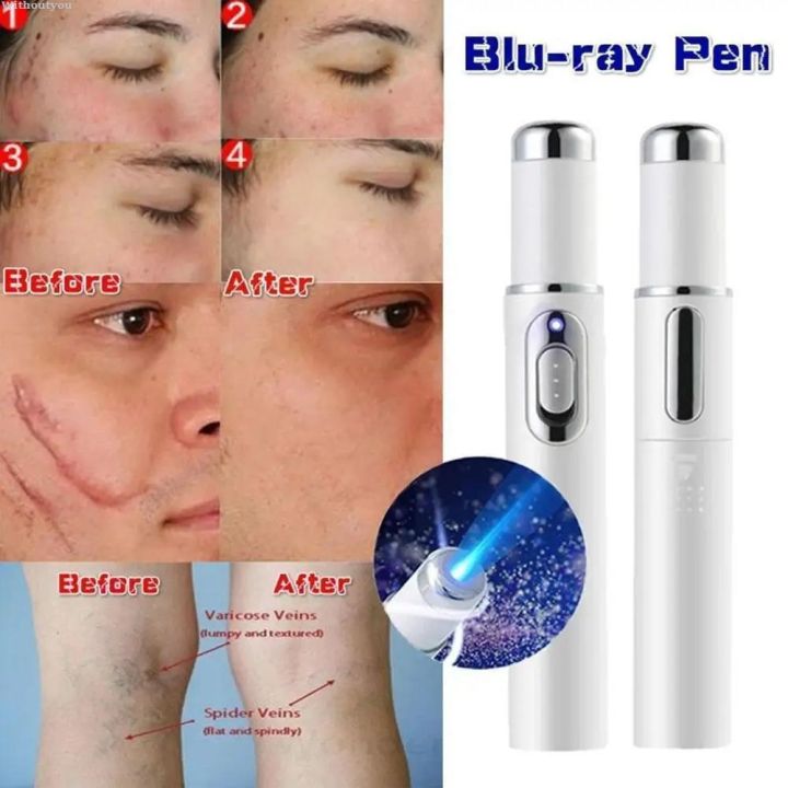Withoutyou Instrument: Facial LED Acne Therapy, Blue Light Laser ...
