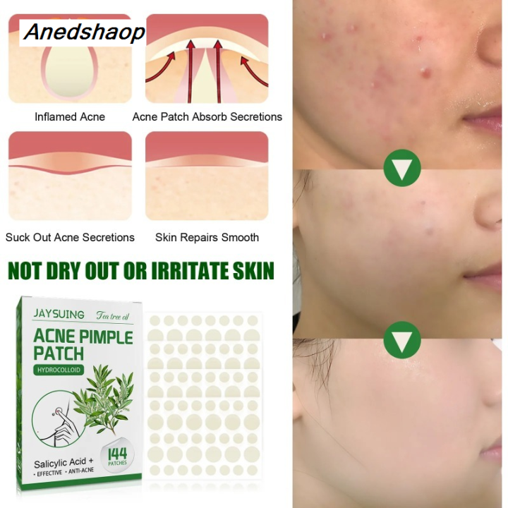 Anedshaop 144/288 Patches Acne Pimple Patch Face Invisible Stickers ...