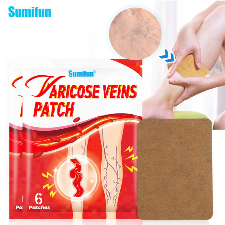 Vasculitis Phlebitis Spider Varicose Veins Patch Varicosity Angiitis ...